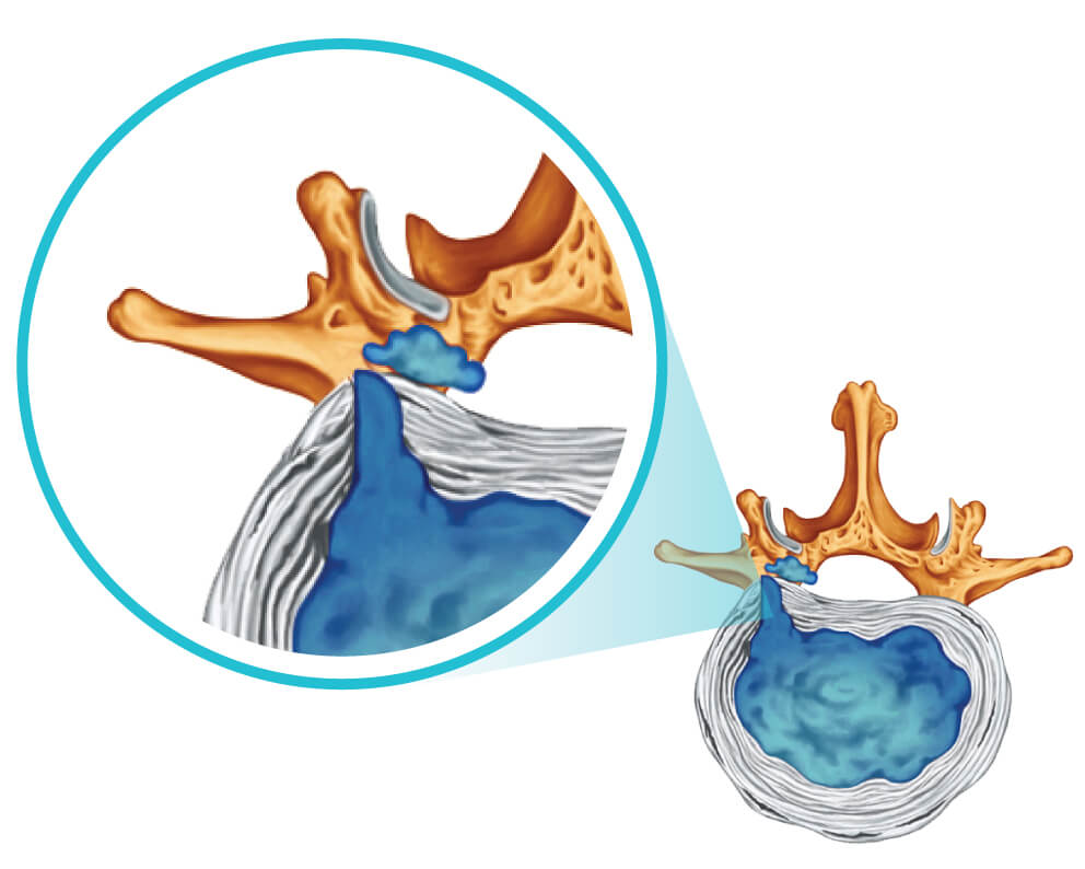 Slip Disc Treatment Kuala Lumpur
